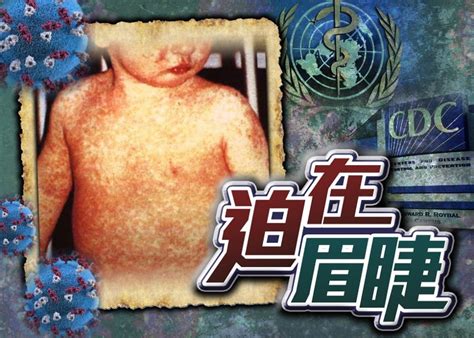 世衞及美國疾控中心警告 麻疹已成全球威脅