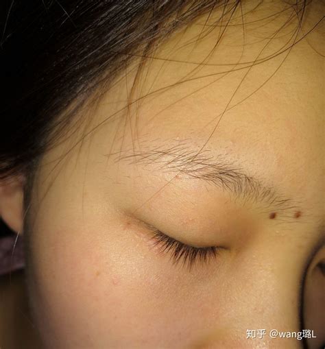 汗管瘤激光 知乎
