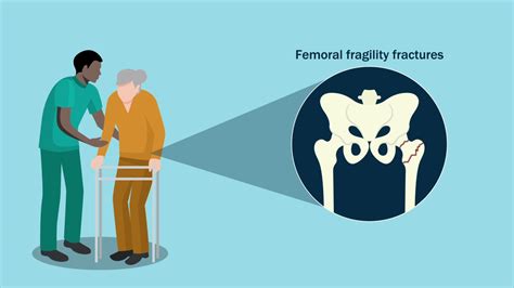 Fragile Hip Fracture At Michael Harbour Blog