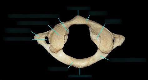 Atypical Cervical Vertebrae Superior View Of C1 Atlas Diagram Quizlet