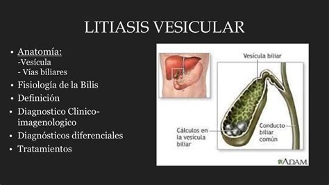 Litiasis Vesicular Alain Chatelet Udocz