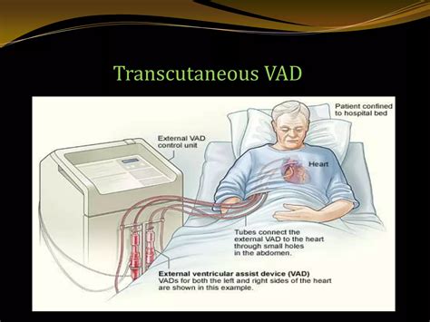 Ventricular Assist Device Pptx