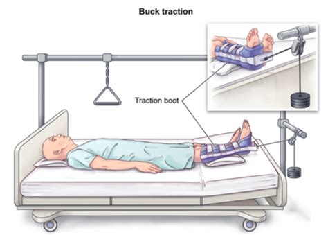 Bucks Traction