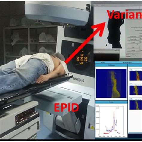 Work Flow Of 3d In Vivo Dose Verification With The Edose System The