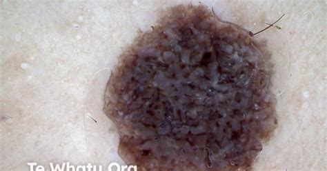 Seborrhoeic Keratosis Polarised Dermoscopy View Image