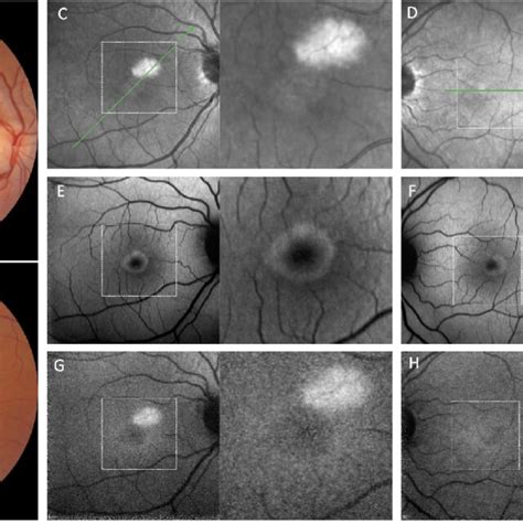 Fundus Photographs A B Show Discrete Alterations In The Macular Download Scientific Diagram