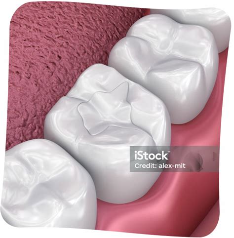Tooth Fillings In Adelaide Cumberland Dental Affordable Treatments