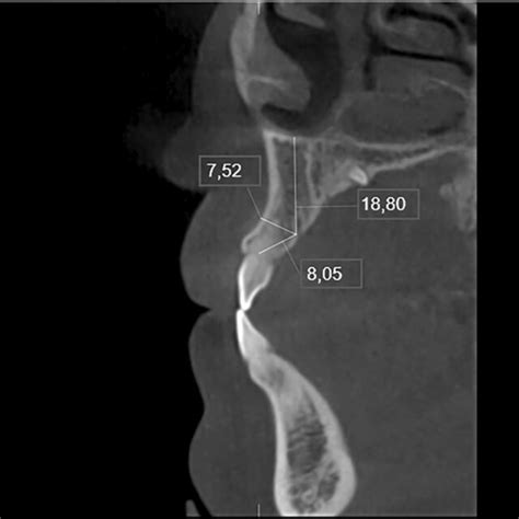 Measurement Of The Diameter Of The Accessory Canal Located In Close
