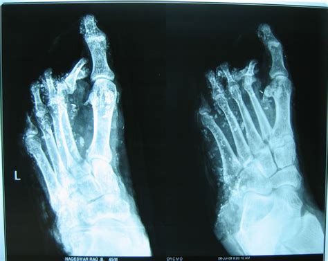 MAJOR CRUSH INJURY FOOT HEEL PAD AVULSION LOWER LIMB INJURY CRUSH INJURY FOOT LOWER LIMB