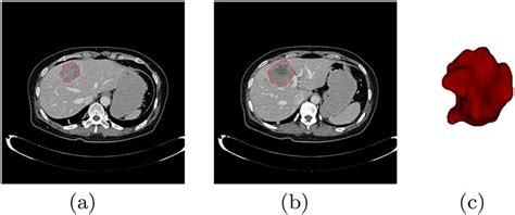Segmentation And 3d Reconstruction Of The Tumour A Ct Scan B