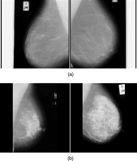 Iasc Free Full Text Cancer Regions In Mammogram Images Using Anfis Classifier Based