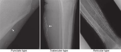 Radiographic Features Of Subcutaneous Calcification Download Scientific Diagram