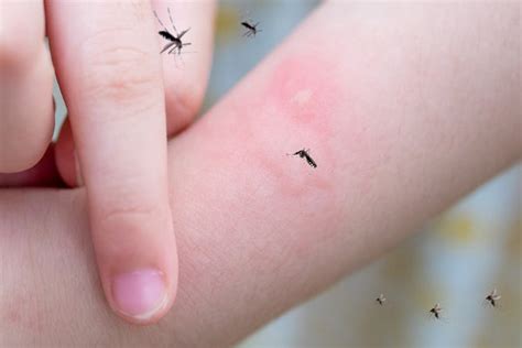 How To Treat Bruises With Mosquito Bites Mosquitonix®