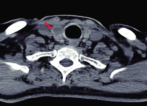 Neck Ct Showing A Hypodense Nodule Within The Right Lobe Of The Thyroid Download Scientific