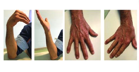 Post Operative Radiographs Showing Anatomic Reduction Of The Scaphoid Download Scientific