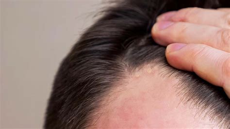 Mild Scalp Folliculitis