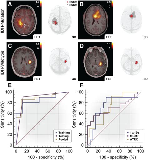 Predictive IDH Genotyping Based On The Evaluation Of Spatial Metabolic