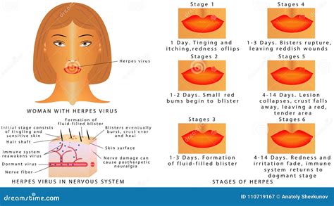 Diagram Of Herpes Simplex Virus Particle Structure Vector Illustration