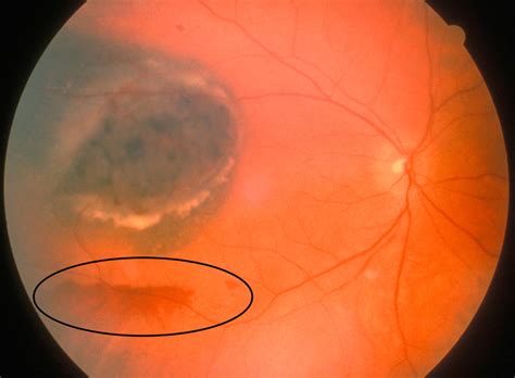 Subretinal Hemorrhage Coms Grading