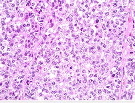 Hematoxylin And Eosin Stain Of A Section Of Tissue From Pathologic Biopsy