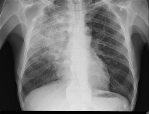 Pneumonia Vs Congestive Heart Failure Difference And Comparison