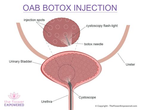 Surgical Treatments For Urinary Incontinence
