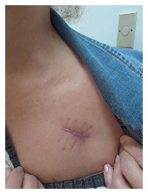 Pacemaker Pocket Site 2 Months After The Removal Of Pacemaker And