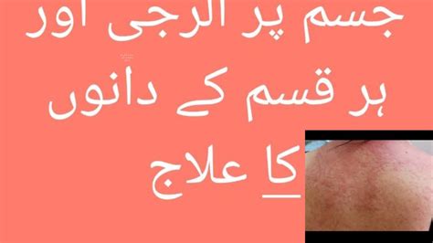 Best Wazifa For Itchy Skin Treatmentkharish Ka Ilaj In Urduhow To