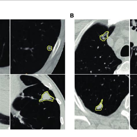 Illustration Of A Benign And B Malignant Pulmonary Nodules In