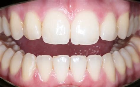 Case Study Invisalign For Rotated Lateral Incisors Simply Teeth