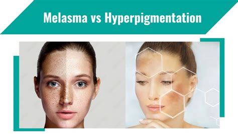 Melasma Vs Hyperpigmentation Know The Difference