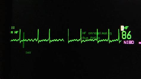 Atrial Fibrillation With Adequate Rate Control On An Ecg Heart Monitor Youtube