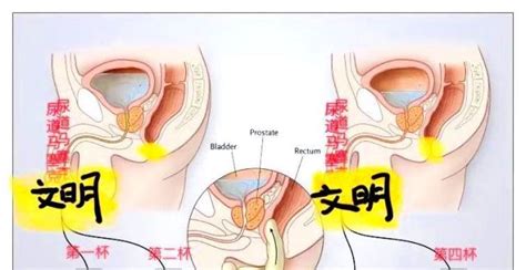 如果准确对前列腺炎进行分类？ 腾讯新闻