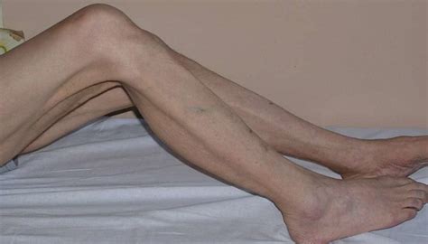 Muscle Atrophy Pictures Muscle Muscle Atrophy Stiwell Feb 22 2020 · However Given That