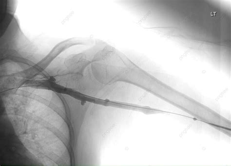 Visual Representation Of Angioplasty Techniques Balloon Angioplasty And