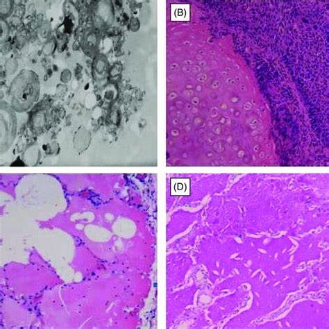 A Ultrastructural Appearance Of Bronchoalveolar Lavage Bal Fluid