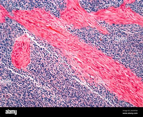 Sarcoma Light Micrograph Of A Section Through A Sarcoma Pink