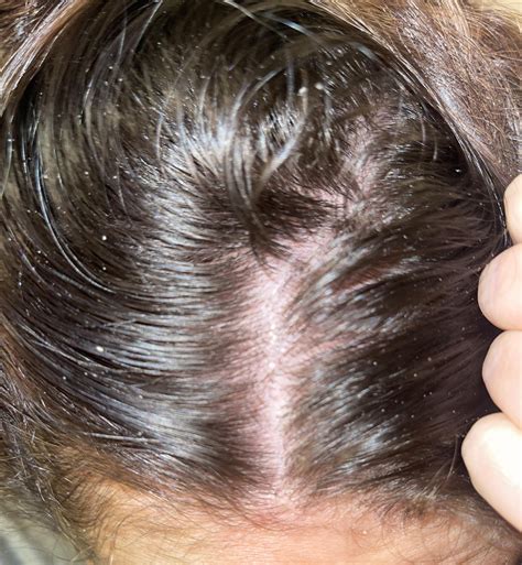Dry Scalp Dandruff Or What Is It R Dermatologyquestions