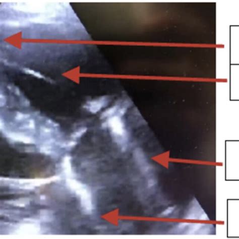 Echocardiographic View Of The Micra Av Pacemaker Medtronic During Download Scientific Diagram