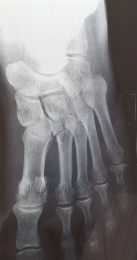 Smashed Foot