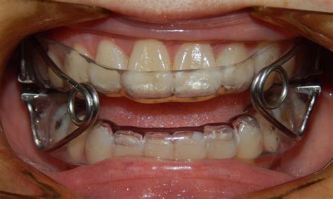 What Is A Tmj Appliance At Kevin Blankenship Blog