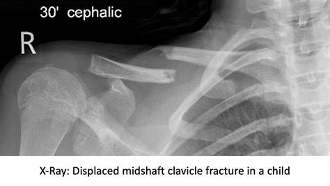 Clavicle Cambridge Shoulder