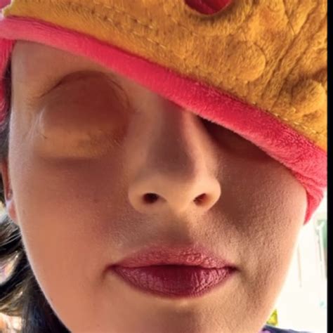 Eye Of The Sarcoma Youtube