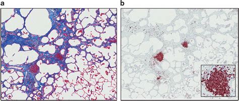 Accumulation Of Cd20 B Cell Aggregates In The Lung Tissue Of Ipf