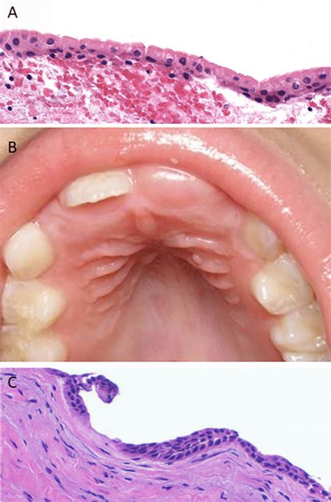 A A Hyperplastic Dental Follicle Demonstrating A Thin Epithelial