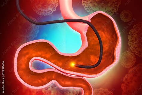 Human Stomach With Endoscope And Close Up View Of Bacterium