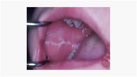 White Patches Inside Lips