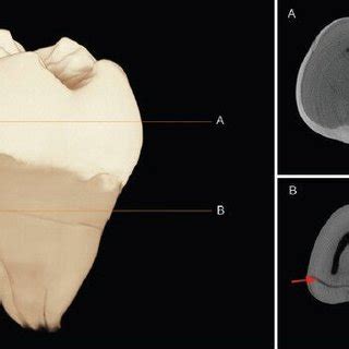 D Surface Rendering With Corresponding Micro CT Slices Of A Burned Download Scientific Diagram