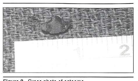 Figure 2 From Synchronous Middle Ear Osteoma And Adenoma Semantic Scholar