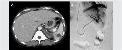 A Ct Angiography Of The Abdomen Showing Splenic Pseudocyst And